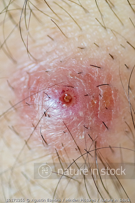 Botfly Humain Human Botfly Stock Photo Minden Pictures